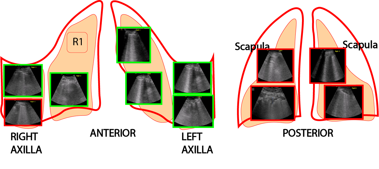 Lung Ultrasound findings in COVID 19 - Critical Care Sonography