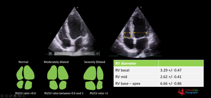Assessment of RV Quiz - Critical Care Sonography