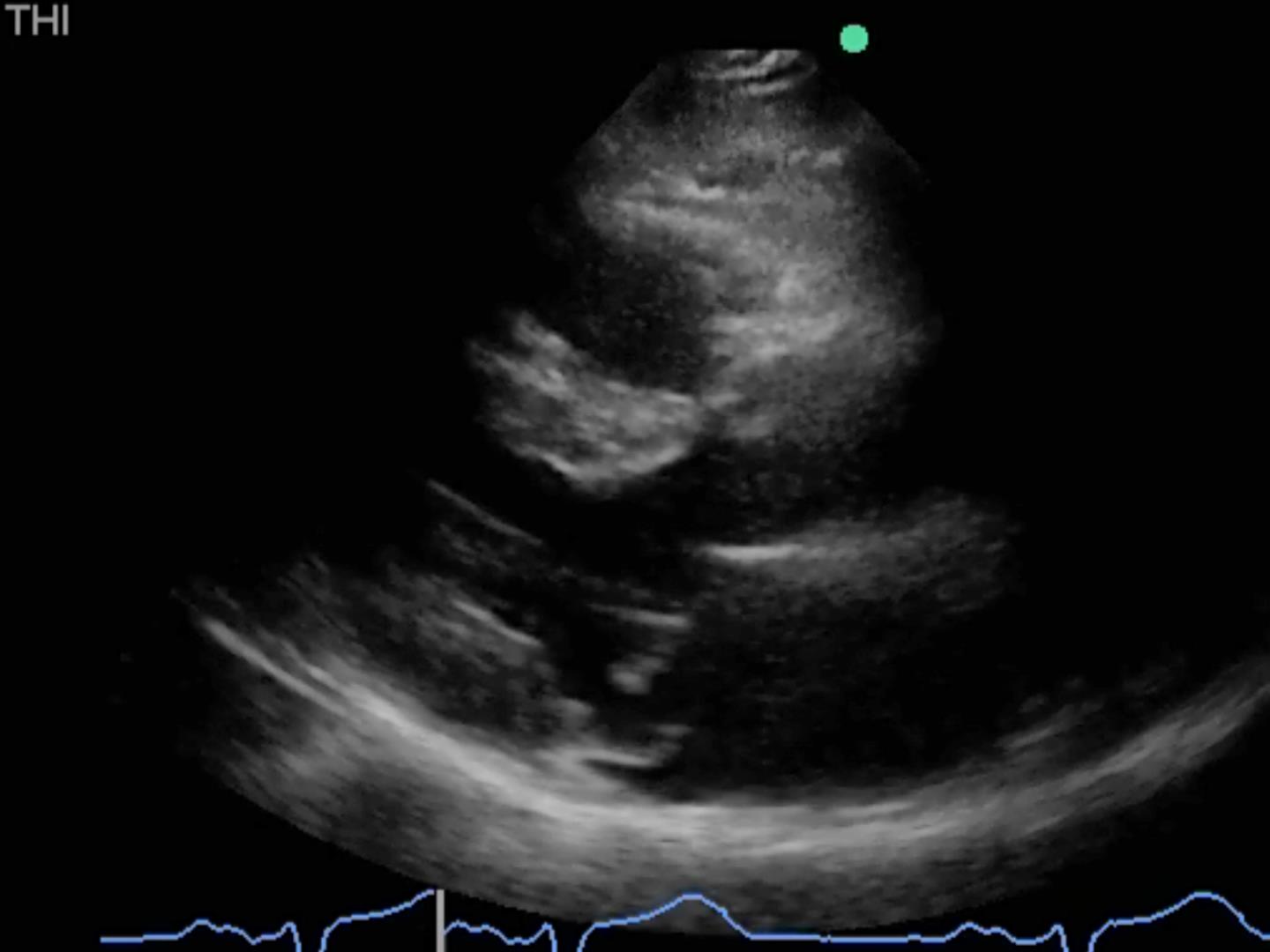 Causes of Mitral Valve Regurgitation - Critical Care Sonography