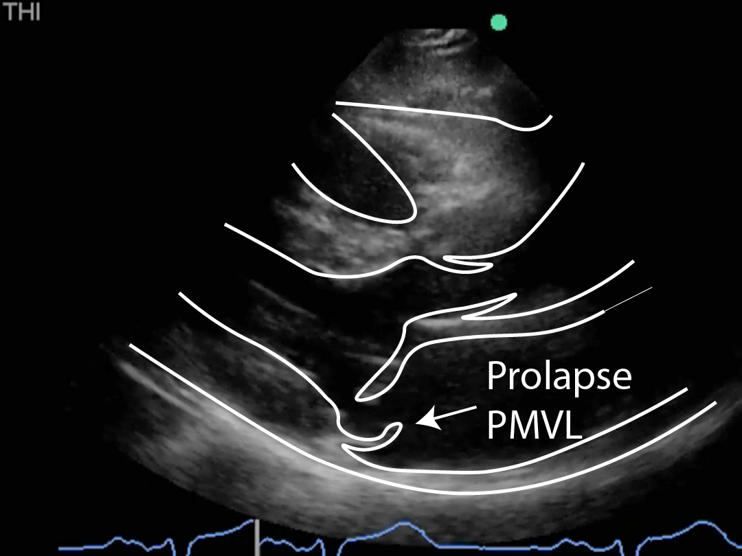 Causes of Mitral Valve Regurgitation - Critical Care Sonography