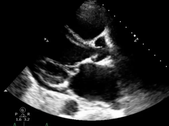 Causes of Mitral Valve Regurgitation - Critical Care Sonography