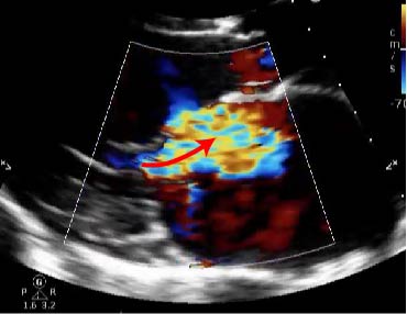 Causes of Mitral Valve Regurgitation - Critical Care Sonography