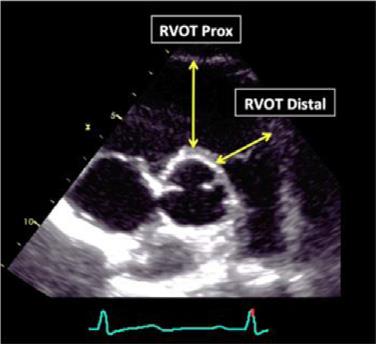 Assessment of RV Quiz - Critical Care Sonography