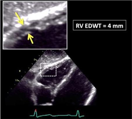 Assessment of RV Quiz - Critical Care Sonography