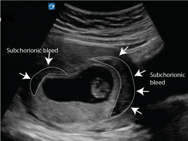 1st trimester Quiz - Critical Care Sonography