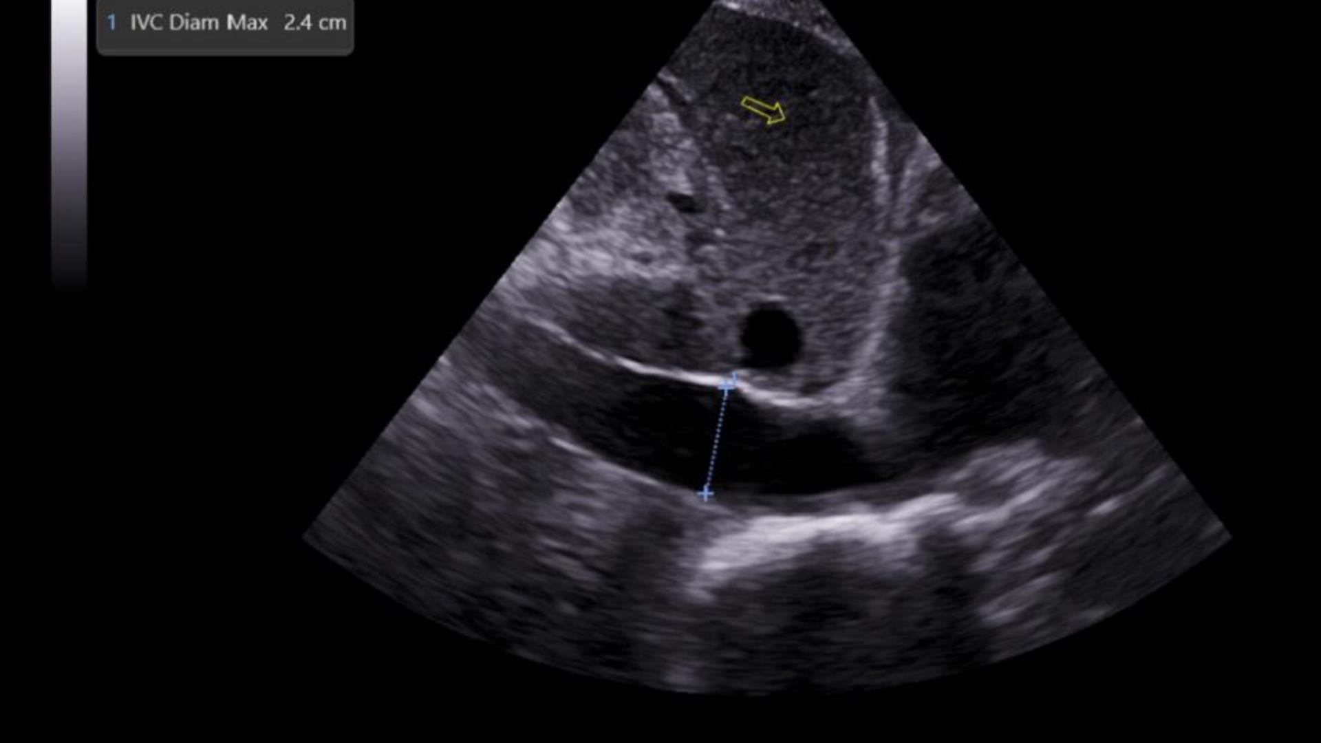 2. Case of the month: FELS Right heart failure - Critical Care Sonography