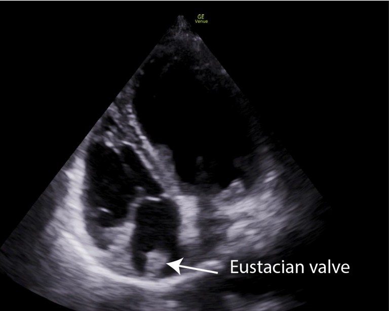 Eustachian valve - Critical Care Sonography