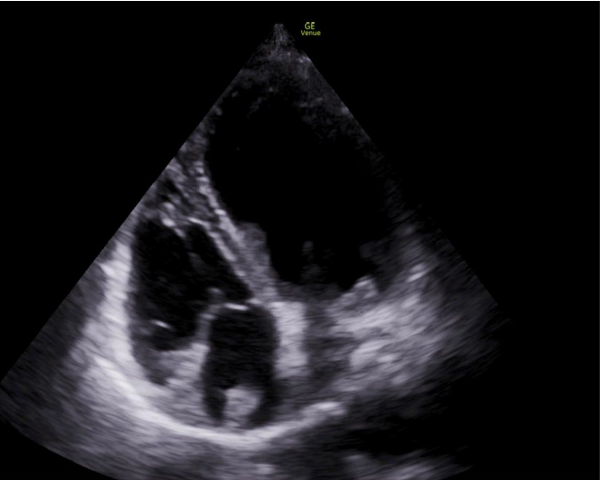 Eustachian valve - Critical Care Sonography