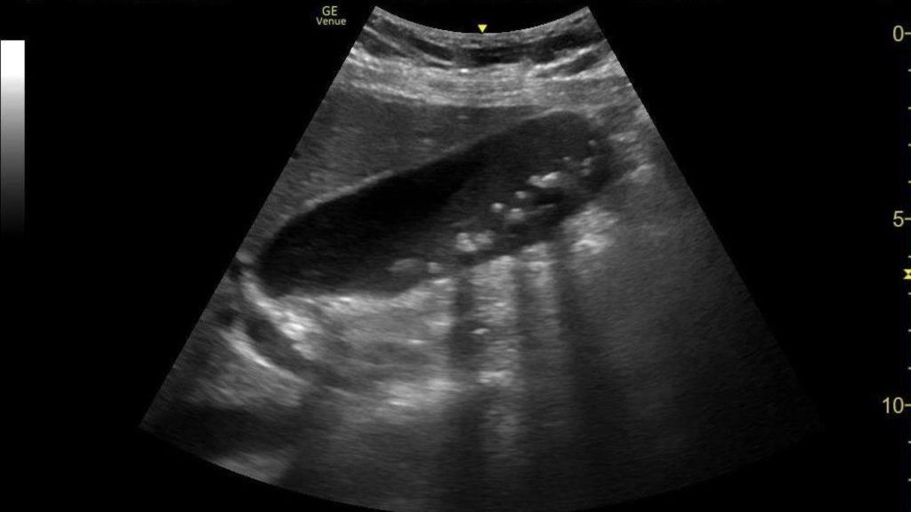3. Case of the month: Gallstones, dilated CBD - Critical Care Sonography