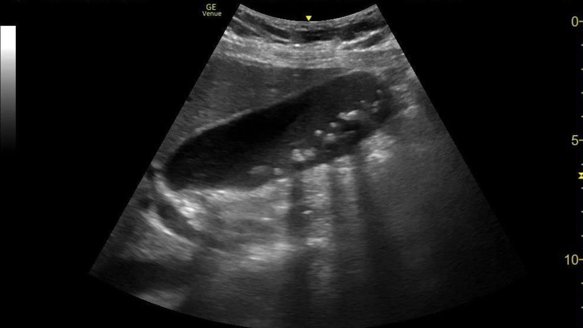 3. Case of the month: Gallstones, dilated CBD - Critical Care Sonography