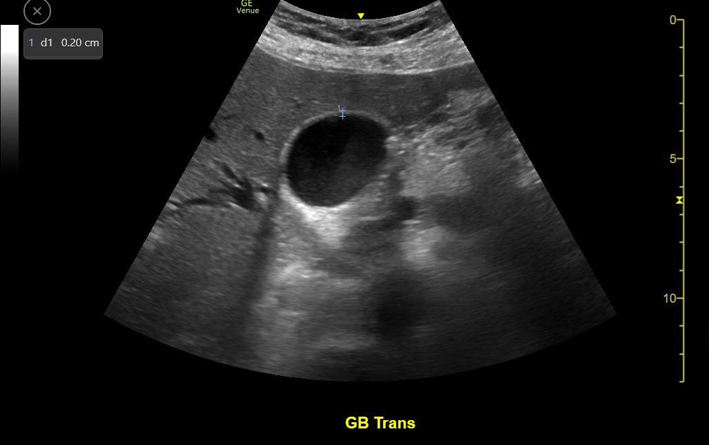 3. Case of the month: Gallstones, dilated CBD - Critical Care Sonography