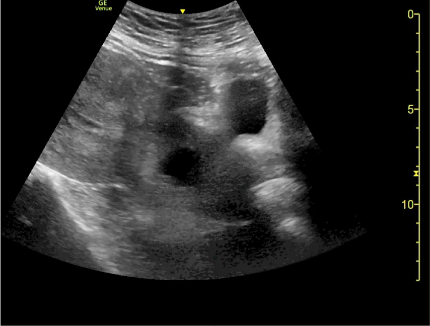 4. Case of the month: Ectopic pregnancy - Critical Care Sonography