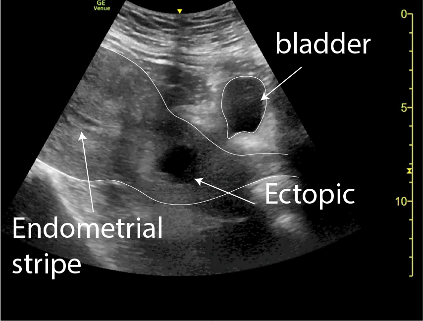 4. Case of the month: Ectopic pregnancy - Critical Care Sonography