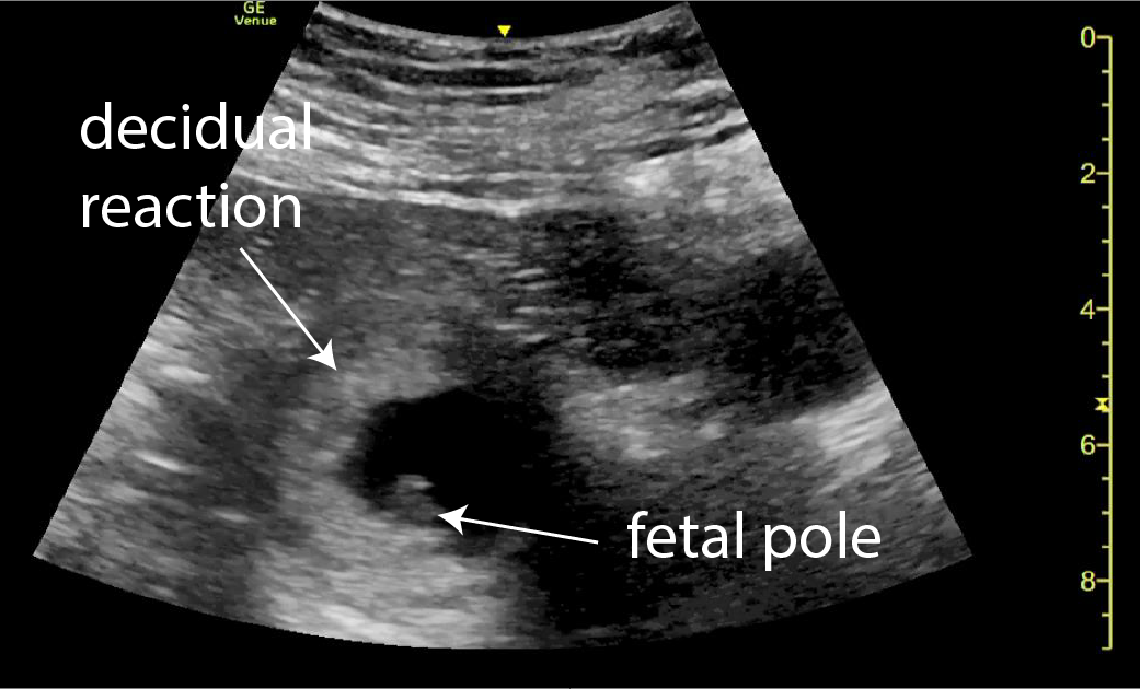 4. Case of the month: Ectopic pregnancy - Critical Care Sonography