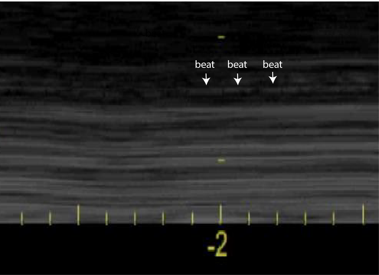4. Case of the month: Ectopic pregnancy - Critical Care Sonography
