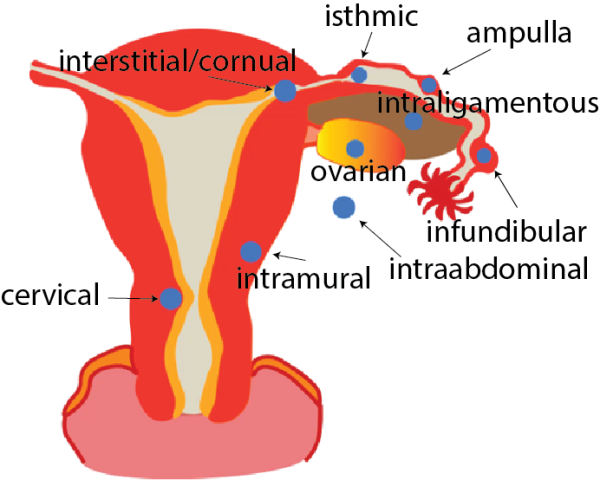 4. Case of the month: Ectopic pregnancy - Critical Care Sonography