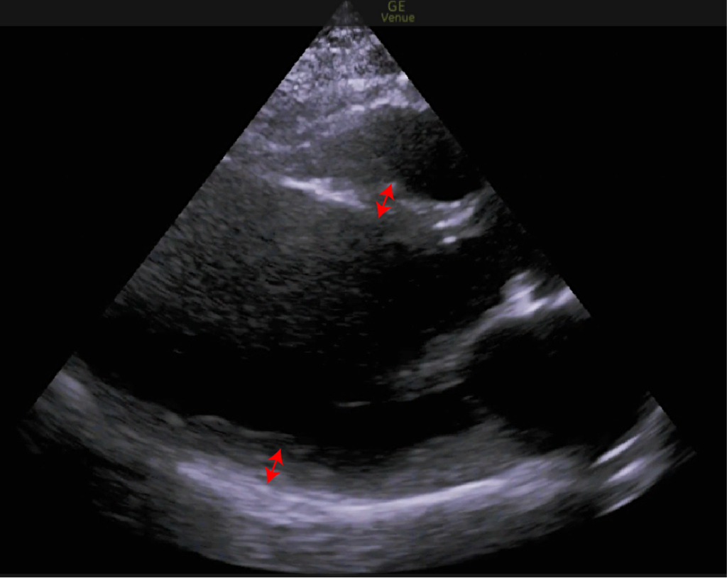 8. Case of the month: Assessment of LV function - Critical Care Sonography