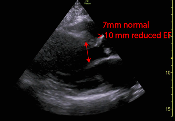 8. Case of the month: Assessment of LV function - Critical Care Sonography