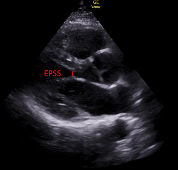 8. Case of the month: Assessment of LV function - Critical Care Sonography