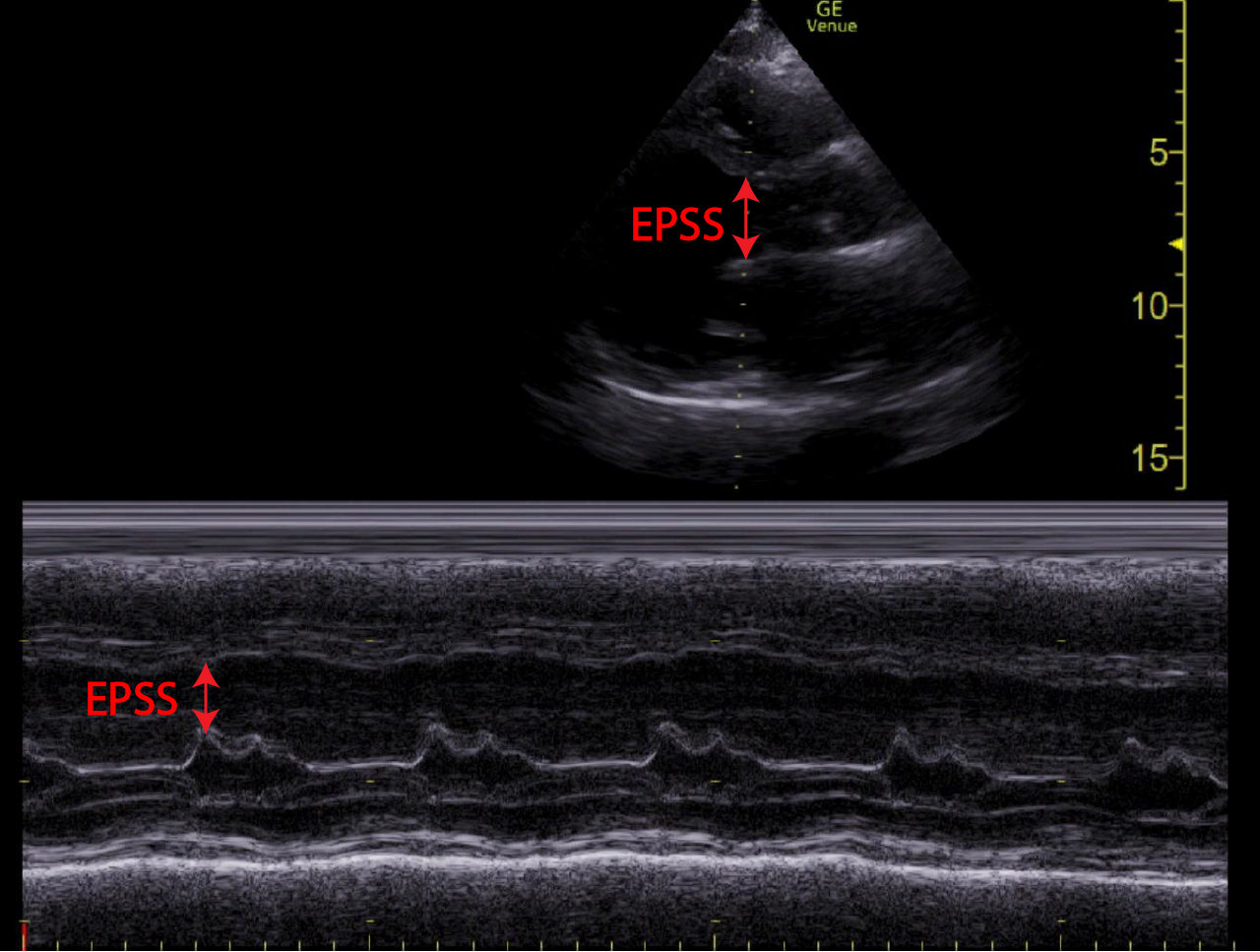 8. Case of the month: Assessment of LV function - Critical Care Sonography