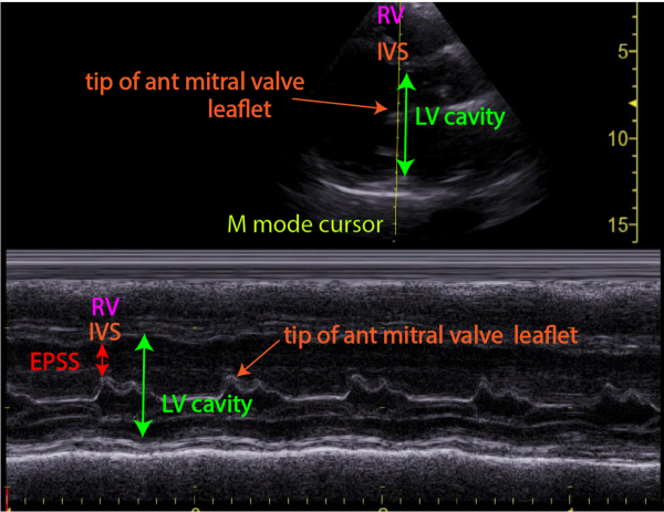 8. Case of the month: Assessment of LV function - Critical Care Sonography