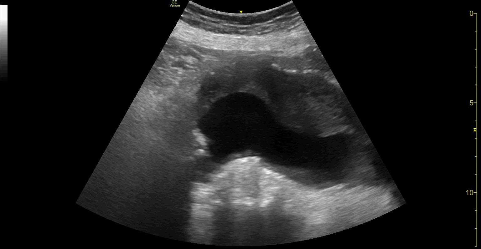 6. Case of the month: AAA - Critical Care Sonography