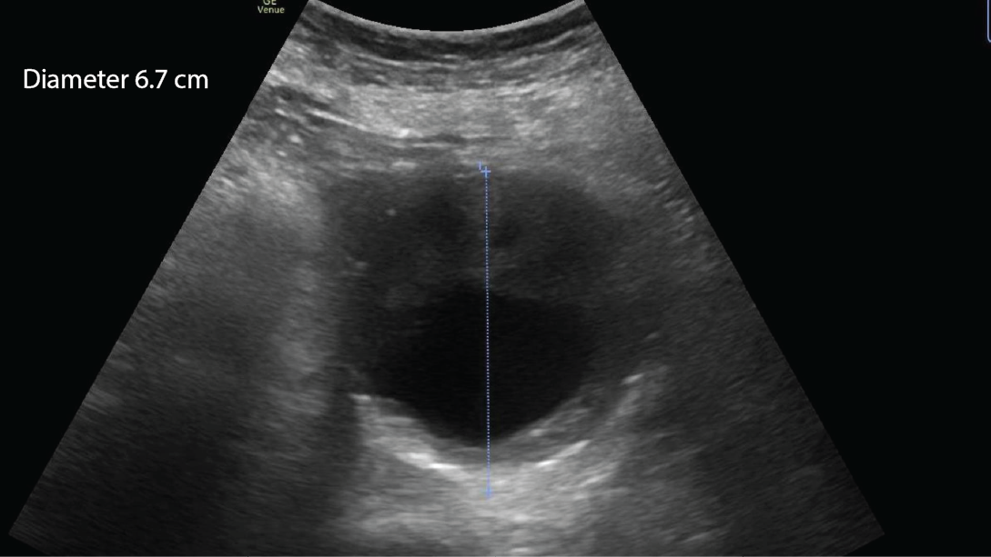6. Case of the month: AAA - Critical Care Sonography