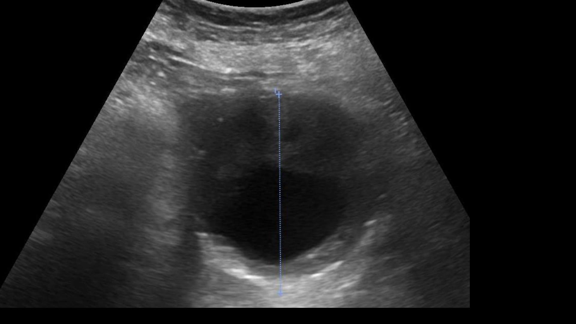 6. Case of the month: AAA - Critical Care Sonography