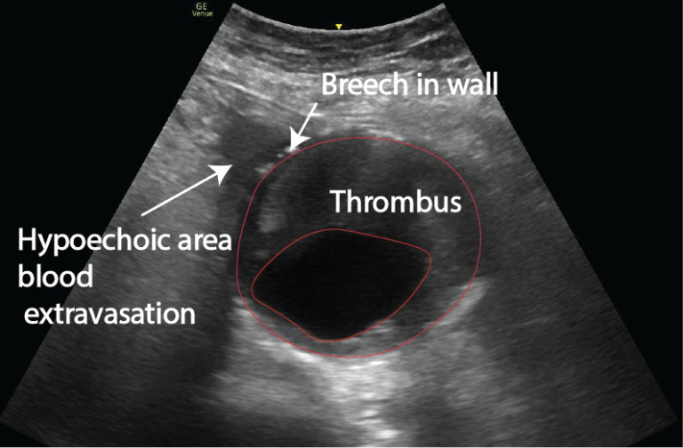 6. Case of the month: AAA - Critical Care Sonography