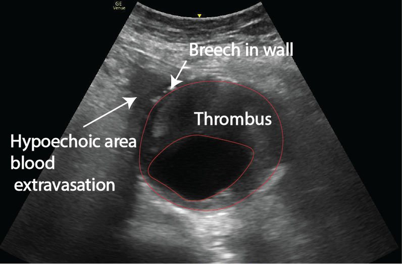6. Case of the month: AAA - Critical Care Sonography