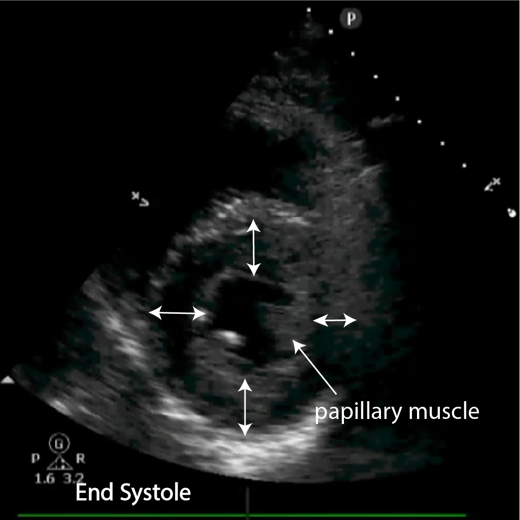 8. Case of the month: Assessment of LV function - Critical Care Sonography