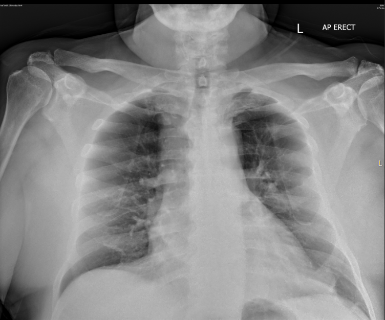 7. Case of the month: Pulmonary Embolism - Critical Care Sonography