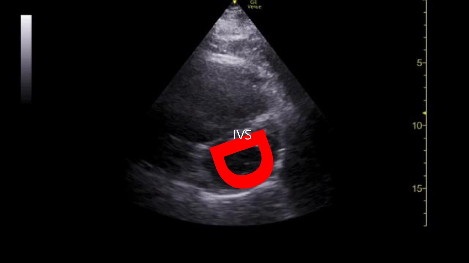 7. Case of the month: Pulmonary Embolism - Critical Care Sonography
