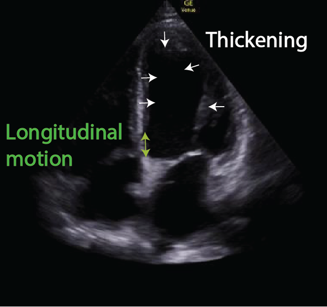 8. Case of the month: Assessment of LV function - Critical Care Sonography