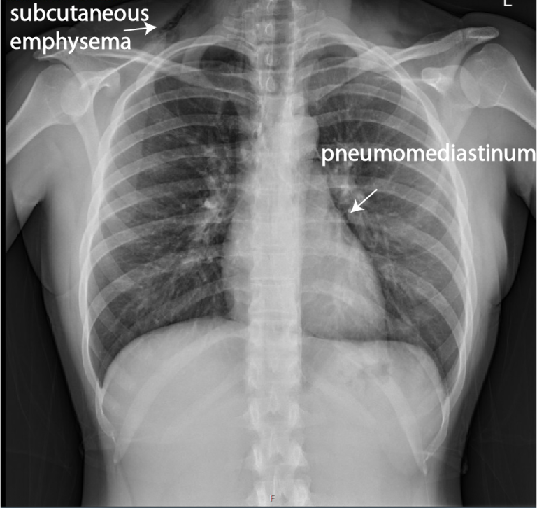 9. Case of the month: PoCUS in pneumomediastinum - Critical Care Sonography