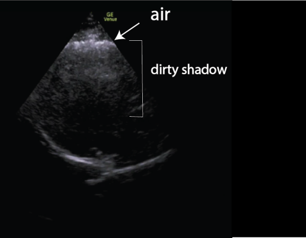 9. Case of the month: PoCUS in pneumomediastinum - Critical Care Sonography