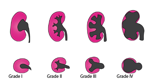 12. Case of the month: Renal colic - Critical Care Sonography