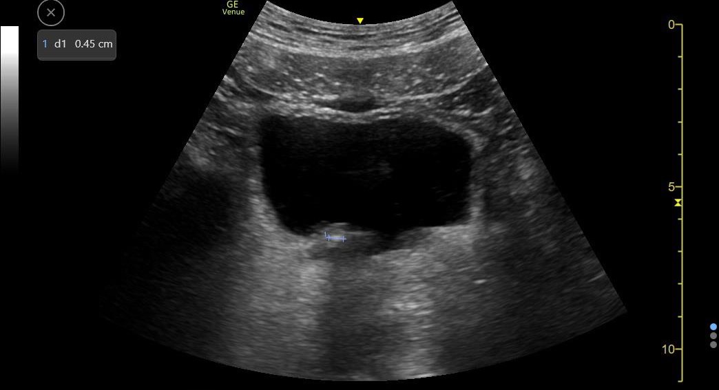 12. Case of the month: Renal colic - Critical Care Sonography