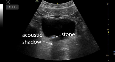 12. Case of the month: Renal colic - Critical Care Sonography