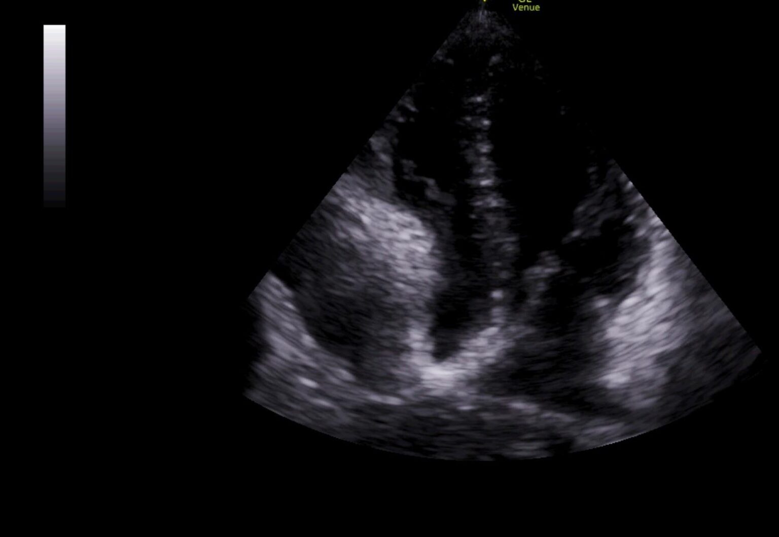 14. Case of the month: RA wall collapse and pleural effusion - Critical ...