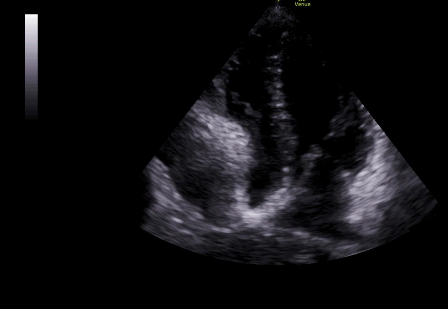 14. Case of the month: RA wall collapse and pleural effusion - Critical ...