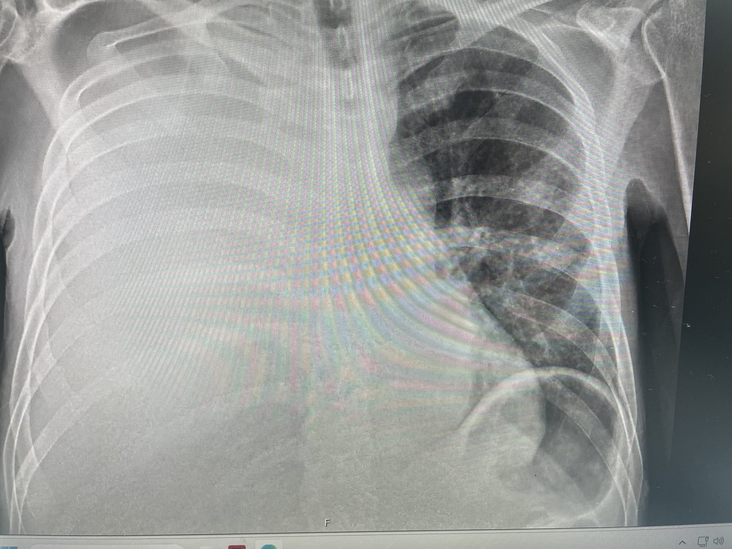 14. Case of the month: RA wall collapse and pleural effusion - Critical ...