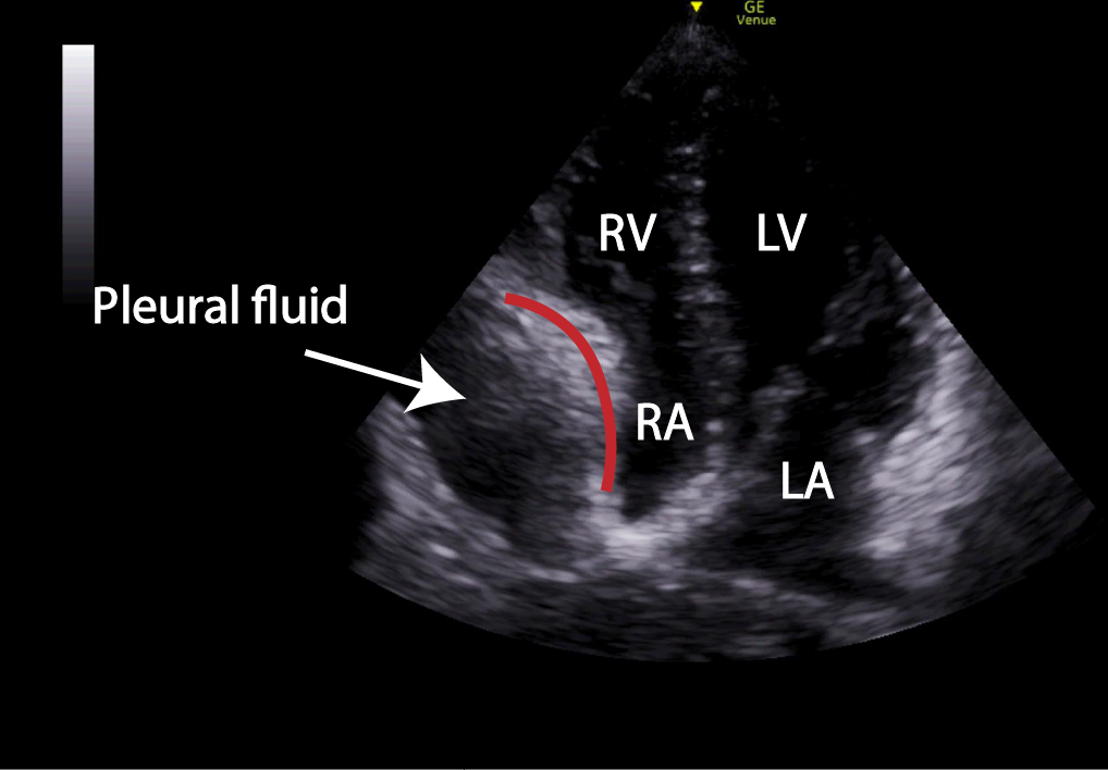 14. Case of the month: RA wall collapse and pleural effusion - Critical ...