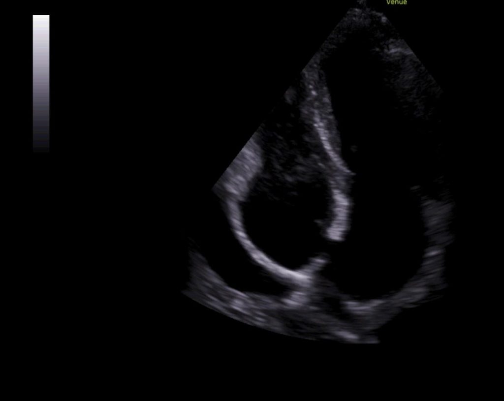 14. Case of the month: RA wall collapse and pleural effusion - Critical ...