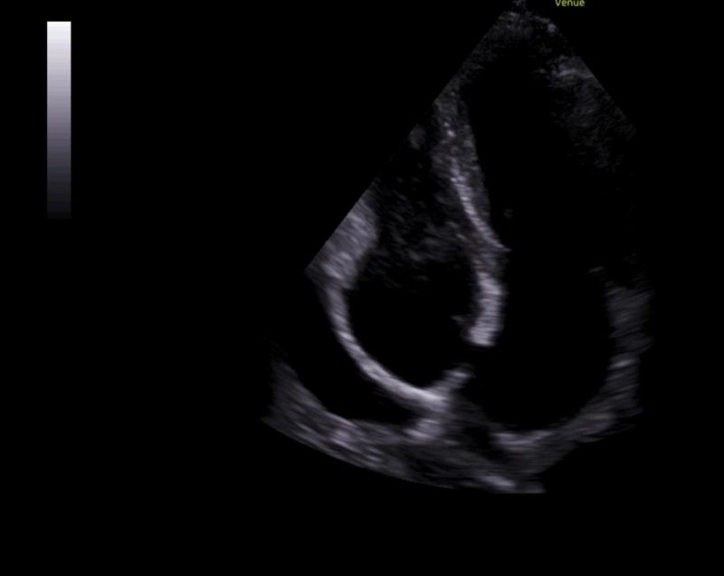 14. Case of the month: RA wall collapse and pleural effusion - Critical ...