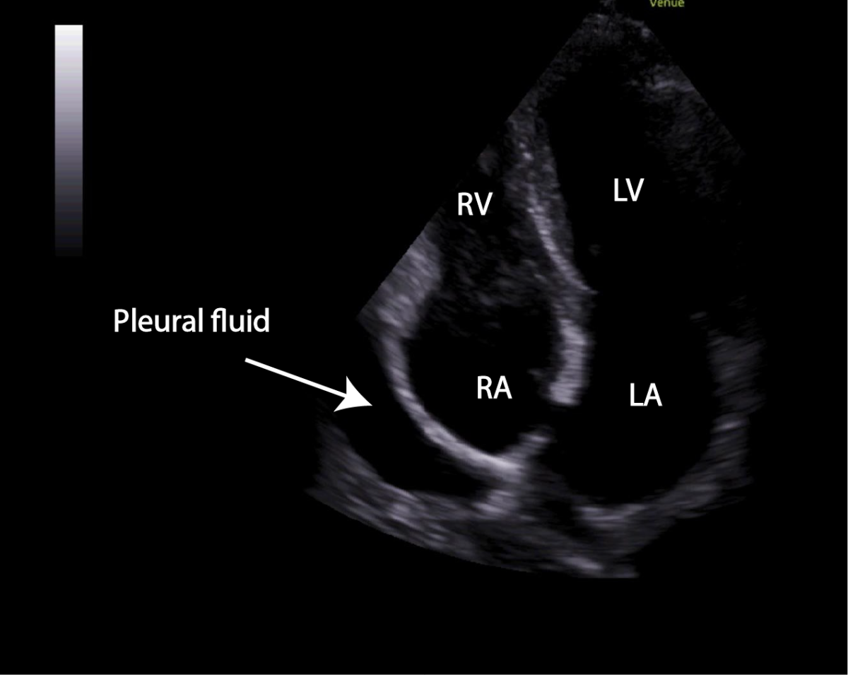 14. Case of the month: RA wall collapse and pleural effusion - Critical ...