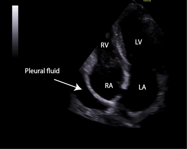 14. Case of the month: RA wall collapse and pleural effusion - Critical ...