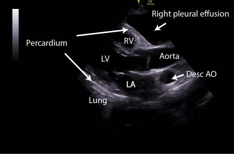 14. Case of the month: RA wall collapse and pleural effusion - Critical ...