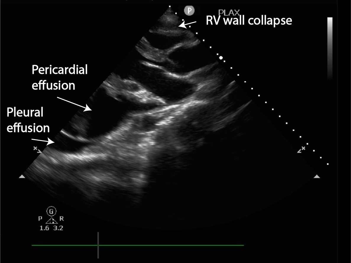 16. Case of the month : TB pericarditis - Critical Care Sonography